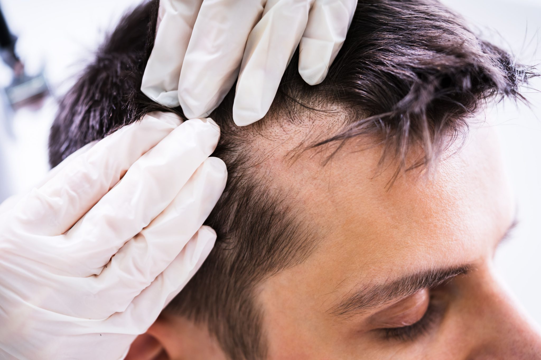 ¿Cuáles son las patologías del cabello más comunes?